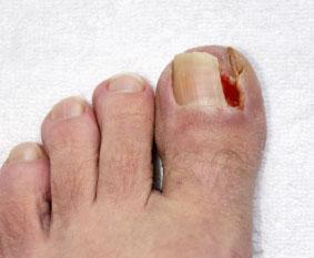 Ingrown Toenails - Island Foot Clinics